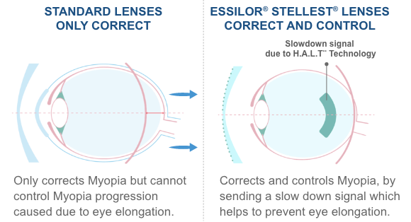 Myopia Control Spectacle Lenses | Myopia Treatment Singapore